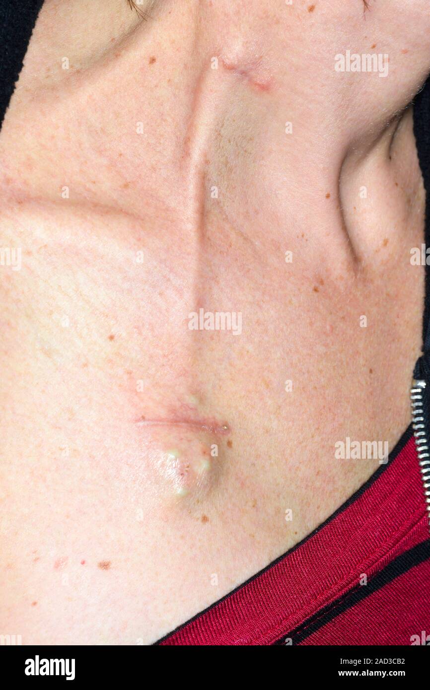 Ovarian cancer treatment port. Close-up of a port (portacath) in situ ...