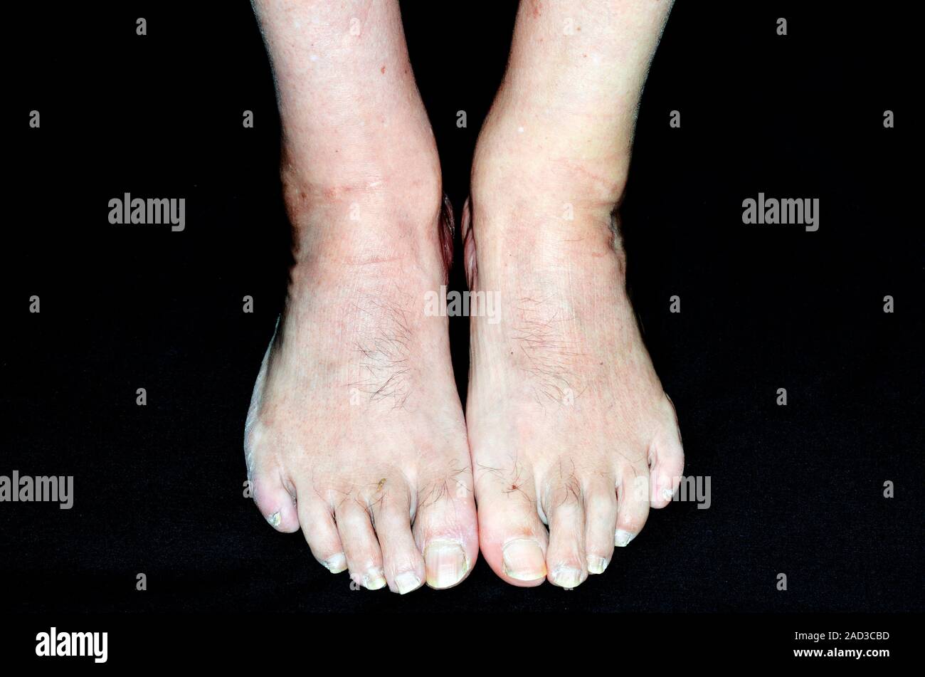 Club foot following surgery in childhood. Close-up of the feet of a 72 ...