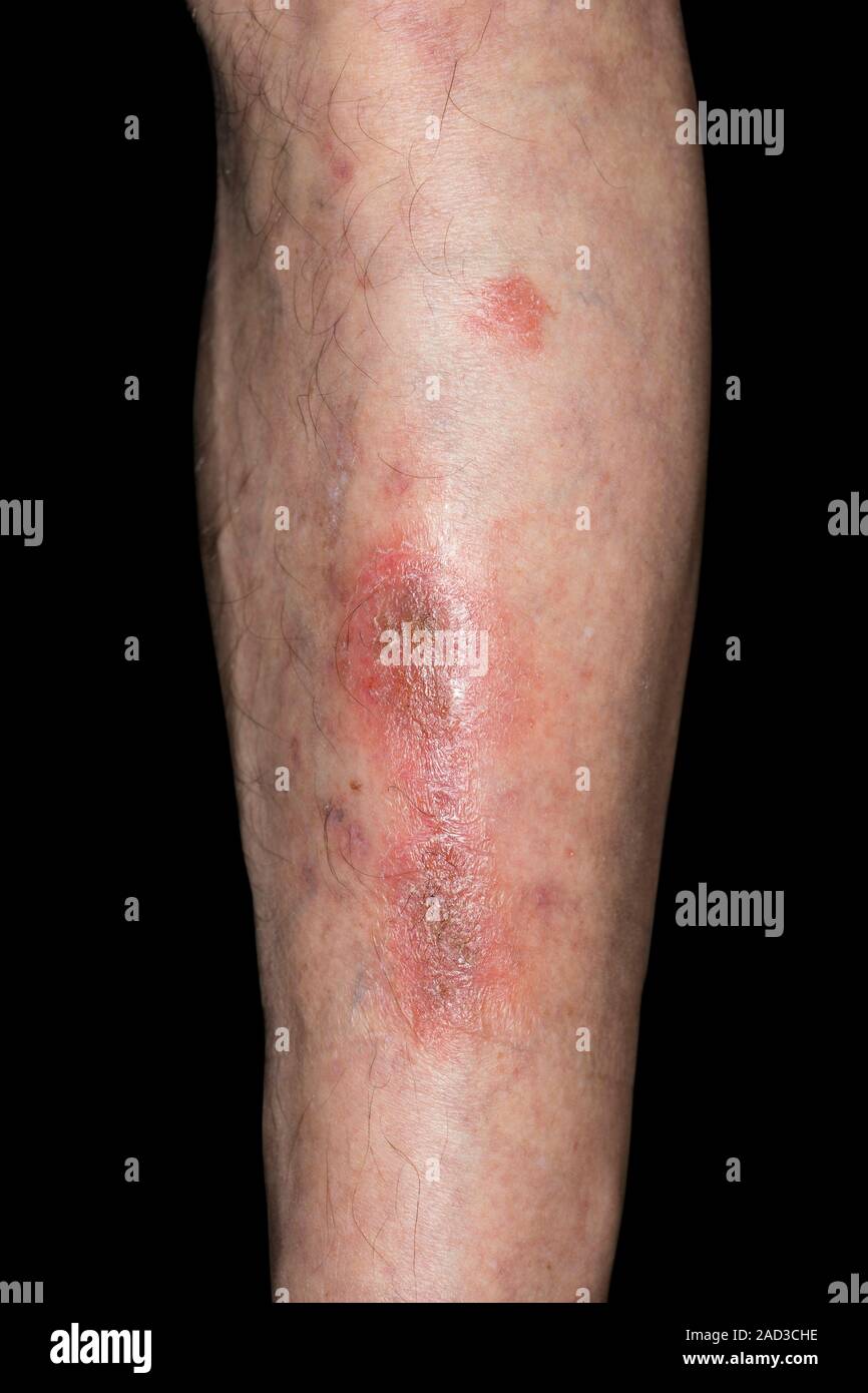 Atopic dermatitis on the leg of a young male patient. Atopic dermatitis ...