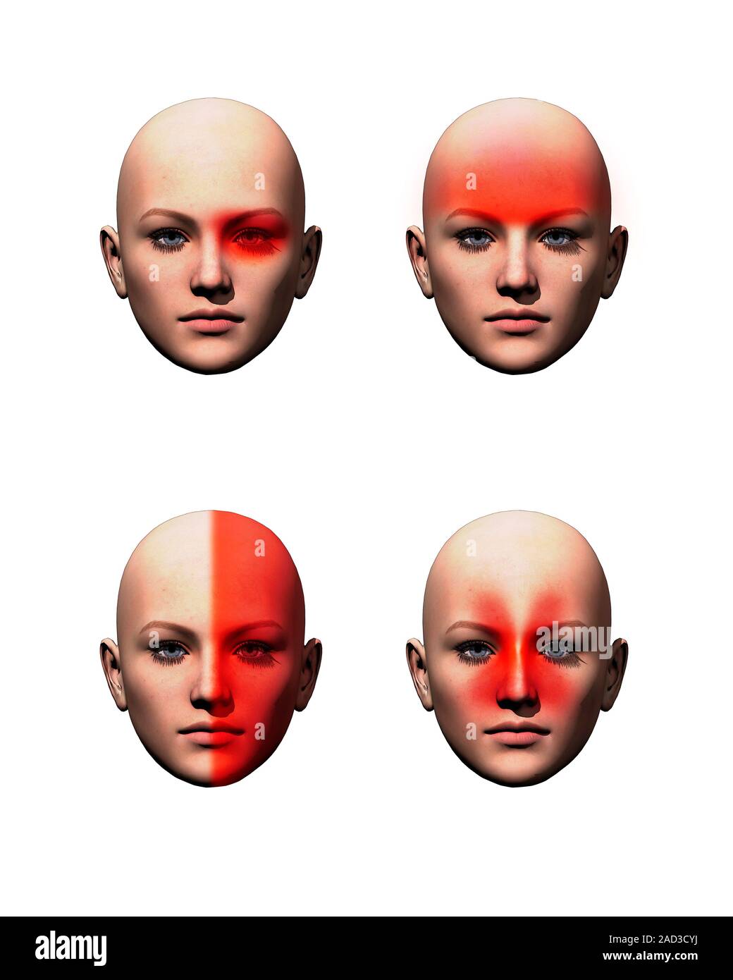 Headache types. Computer illustration showing the areas of the head ...
