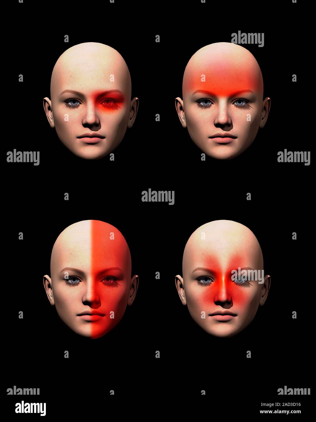 Headache types. Computer illustration showing the areas of the head ...