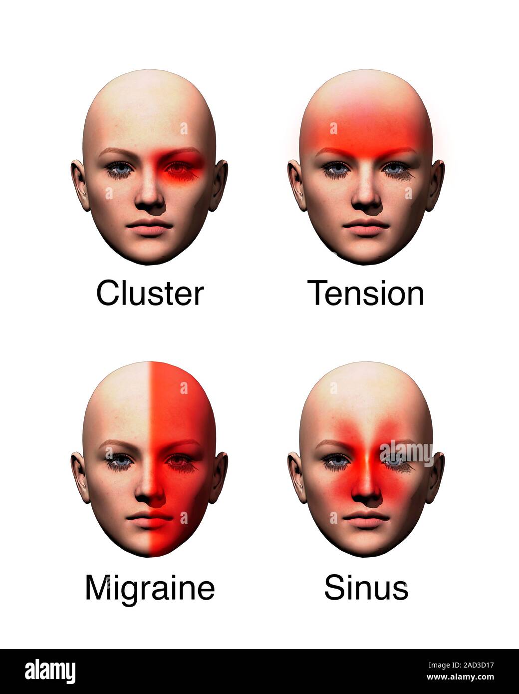 Headache types. Computer illustration showing the areas of the head ...