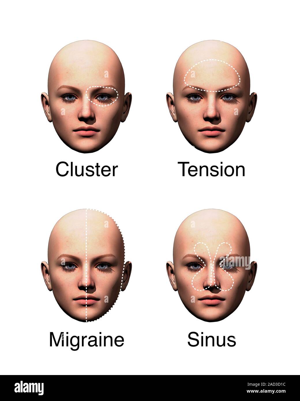 Headache types. Computer illustration showing the areas of the head ...