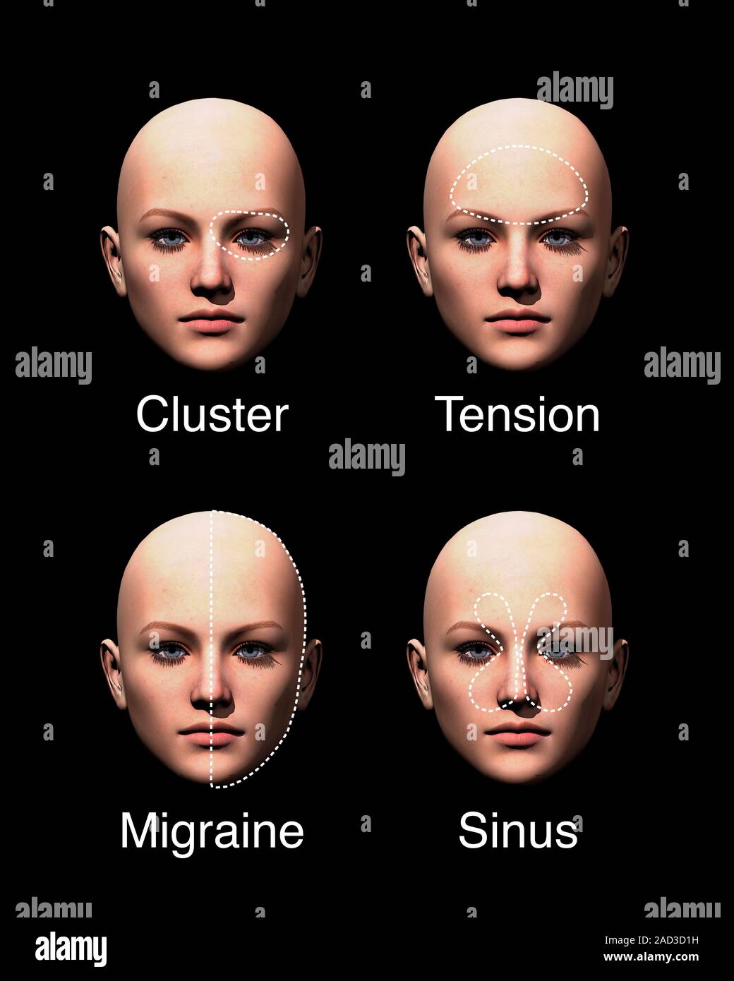 Headache types. Computer illustration showing the areas of the head ...