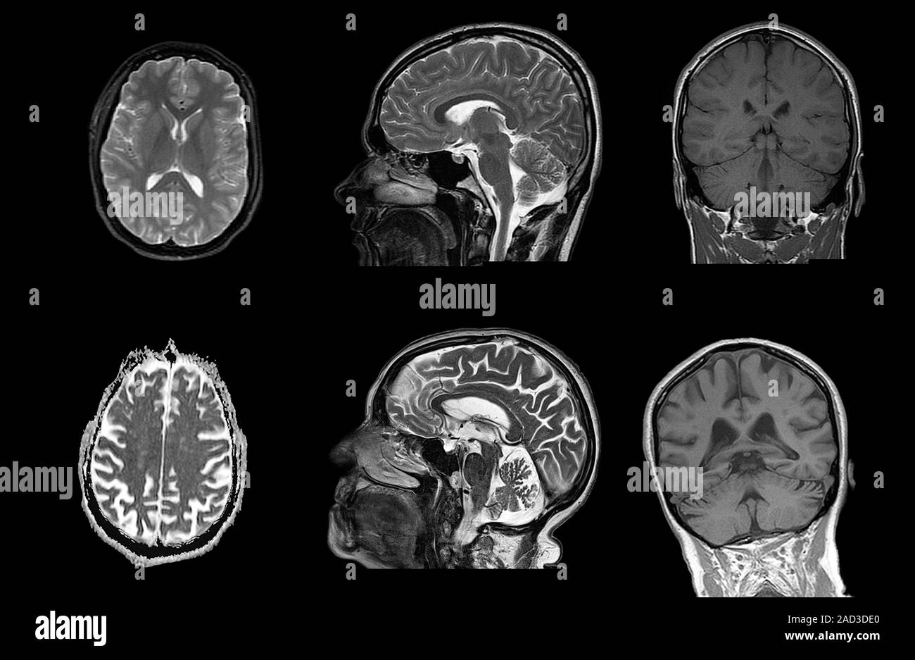 Brain changes with ageing. Composite magnetic resonance imaging (MRI ...