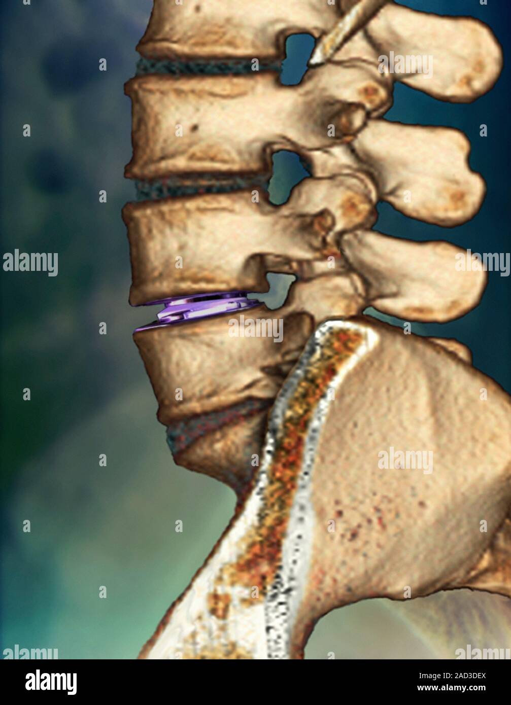 Spinal disc implant. 3D coloured computed tomography (CT) scan of a the ...