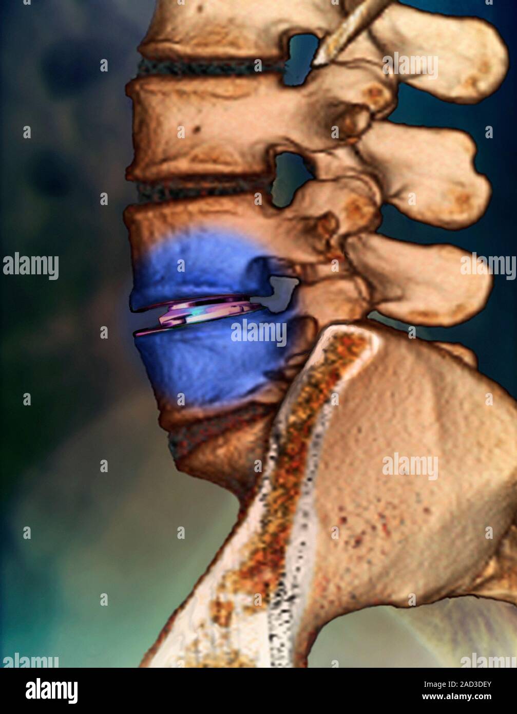 Spinal disc implant. 3D coloured computed tomography (CT) scan of a the ...