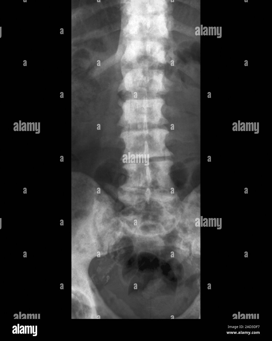 Secondary spinal cancer. Frontal X-ray showing malignant (cancerous ...