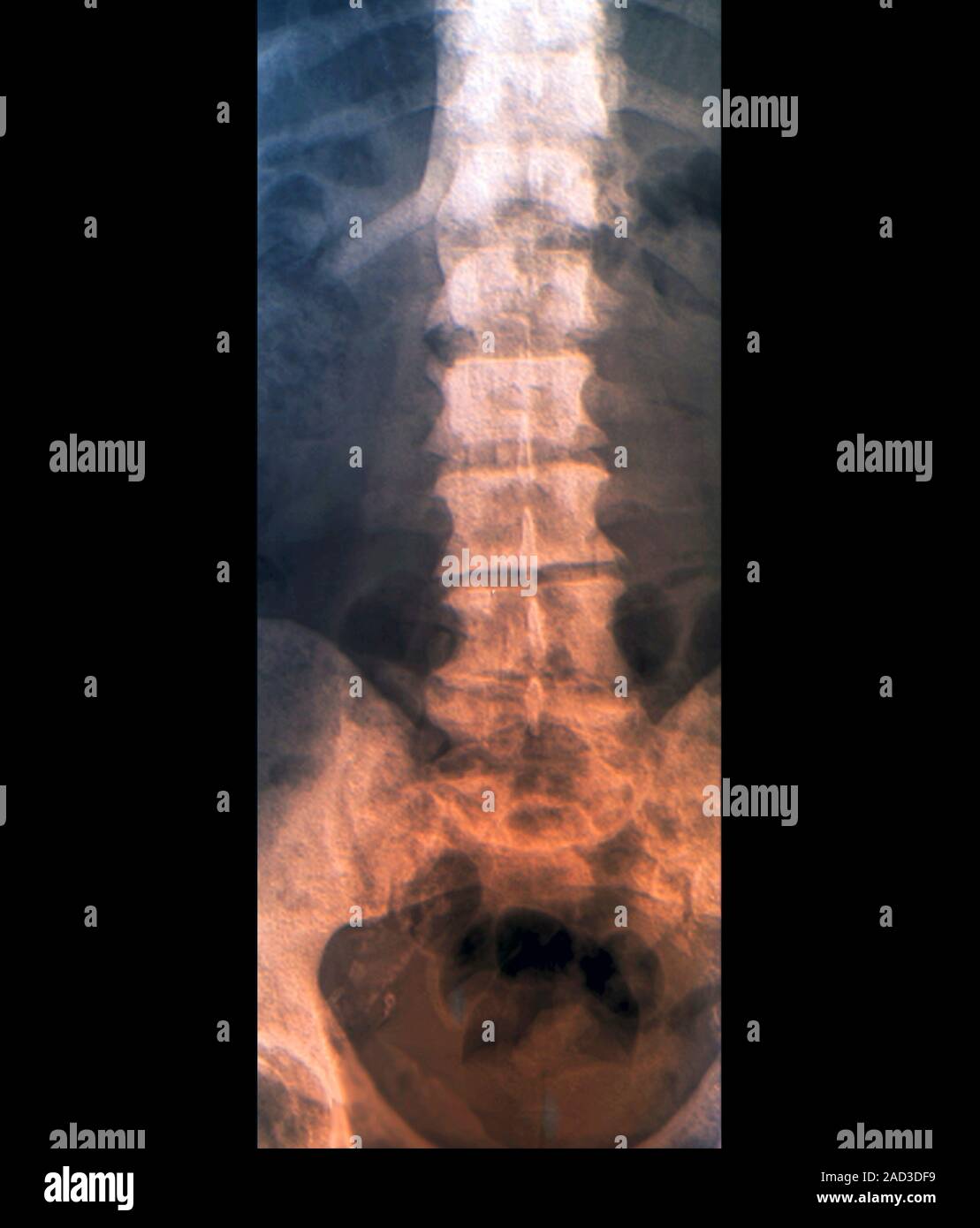 Secondary spinal cancer. Coloured frontal X-ray showing malignant ...