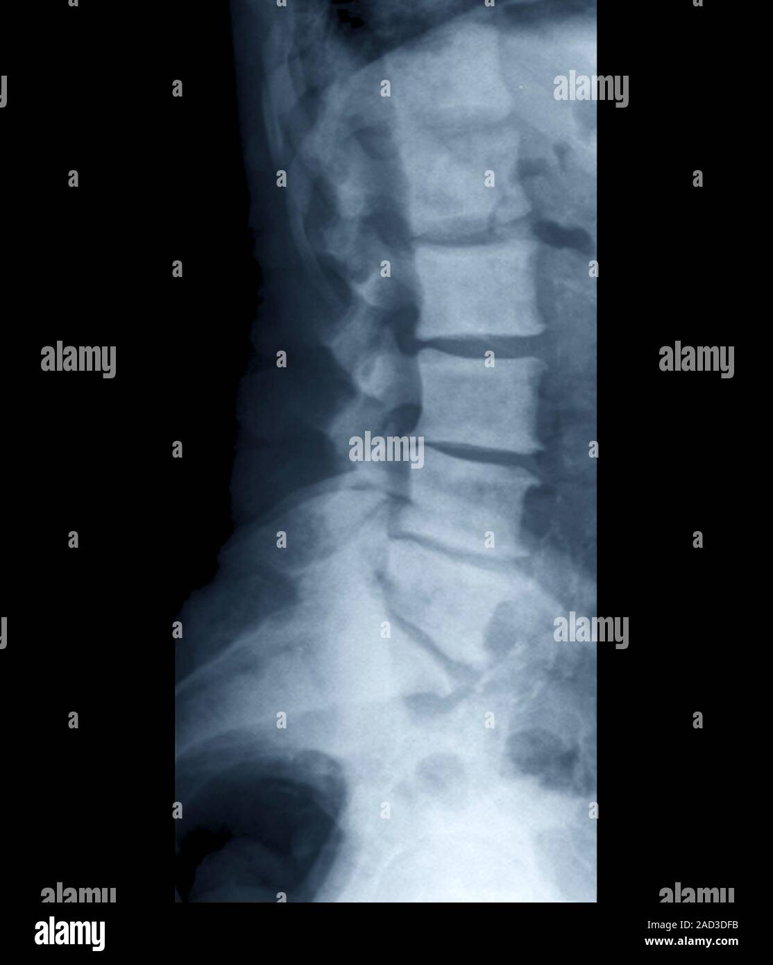 Secondary spinal cancer. Coloured frontal X-ray showing malignant ...