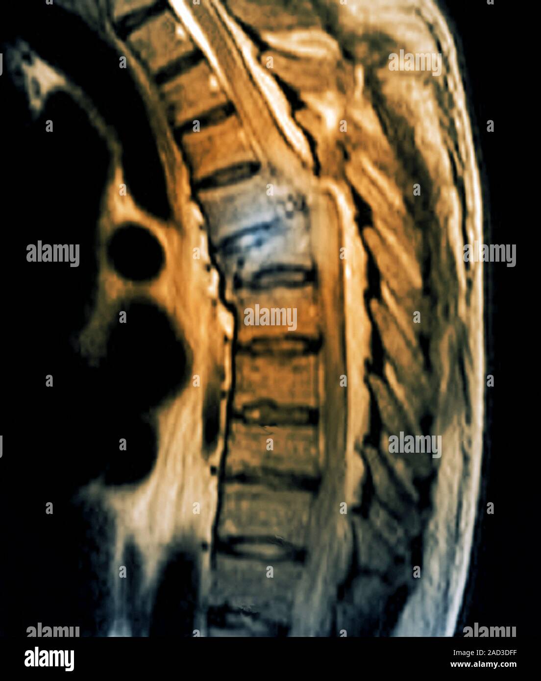 Spinal compression fracture. Coloured magnetic resonance imaging (MRI ...