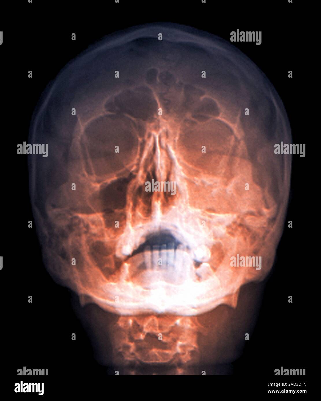 Fractured skull. Coloured frontal X-ray of a section through the head ...