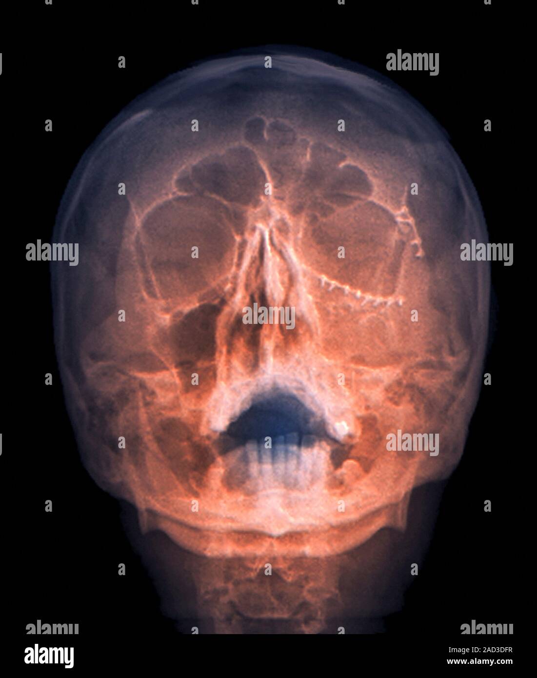Fixed skull fractures. Coloured frontal X-ray of a section through the ...