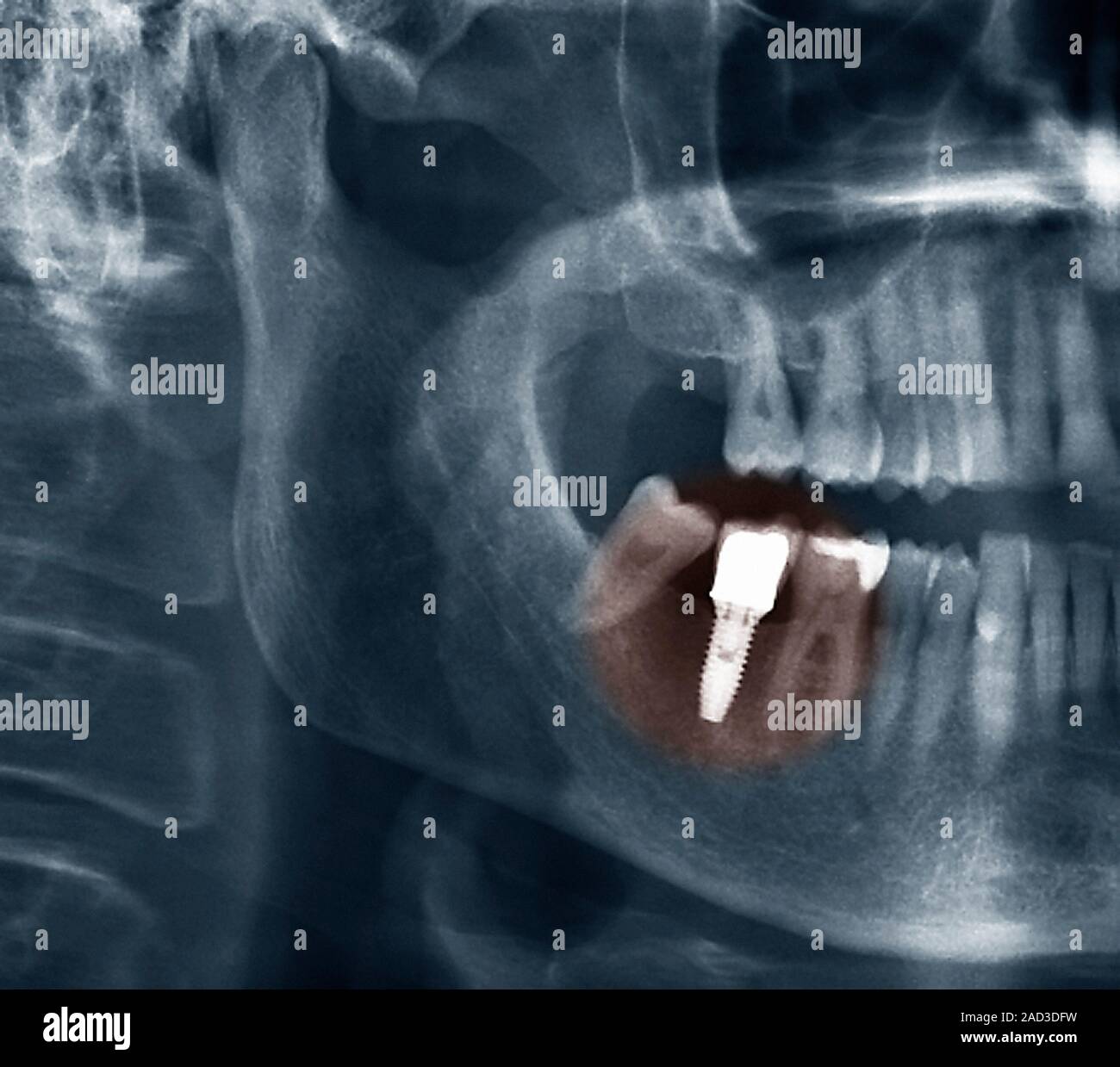 Dental implant. Coloured X-ray of a section through the jaw of a 68 ...