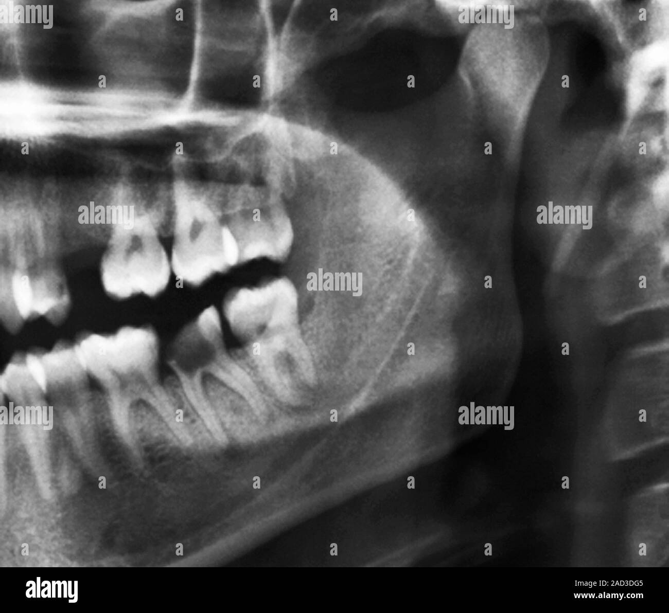 Tooth decay. Coloured X-ray of a section through the jaw of a 29-year ...
