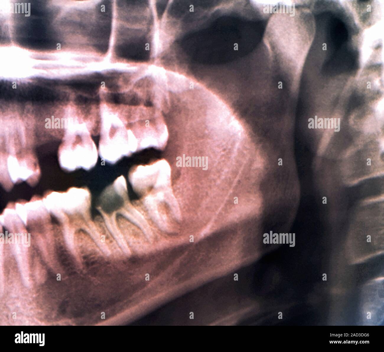 Tooth decay. X-ray of a section through the jaw of a 29-year-old ...