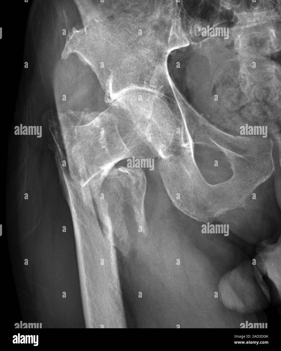 Fractured hip. Frontal X-ray of a section through the hip of a 75-year ...