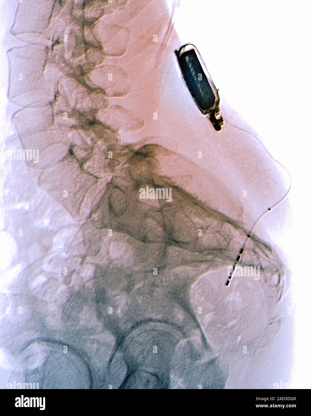 Incontinence implant. Coloured X-ray of a section through the pelvic ...