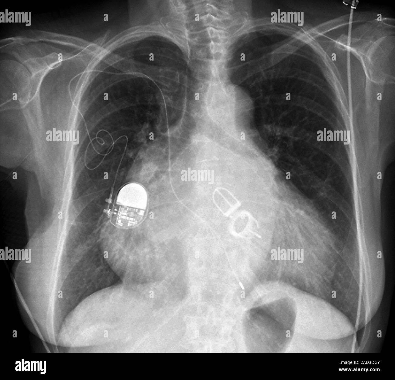 Pacemaker and artificial heart valves. Frontal chest X-ray of a 71-year ...