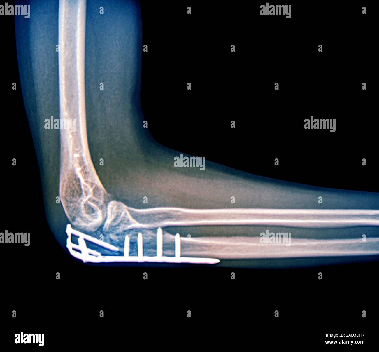 Fixed broken elbow. Coloured X-ray of a section through the left arm of ...
