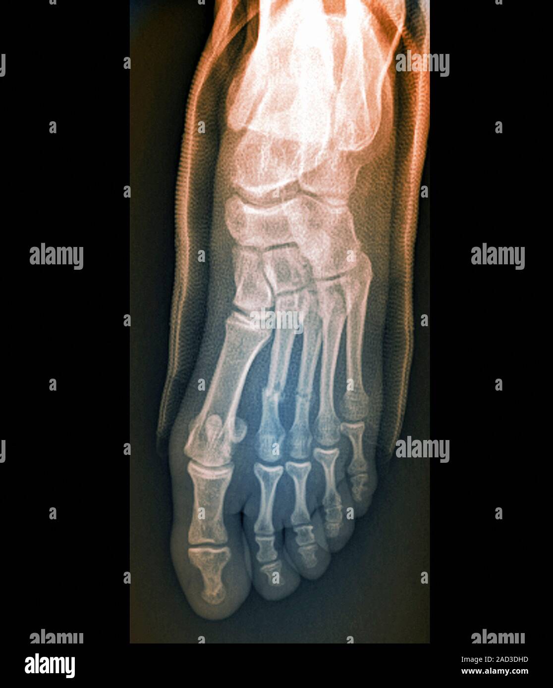 Broken toe in plaster. Coloured X-ray of a section through the left ...