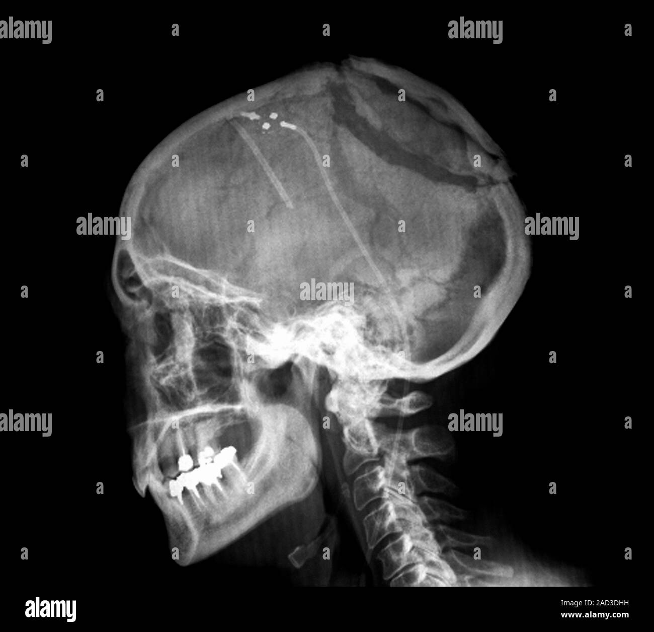 Ventricular shunt in brain tumour. X-ray of a section through the head ...