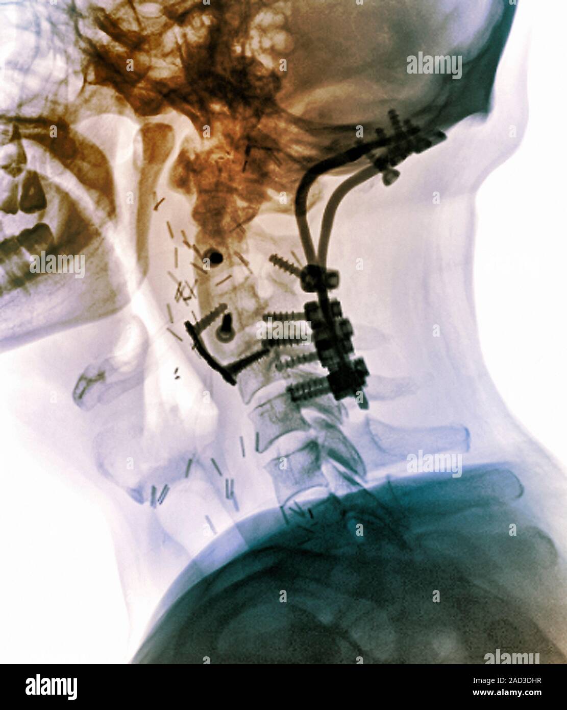 Fixed broken neck. Coloured X-ray of a section through the head and ...