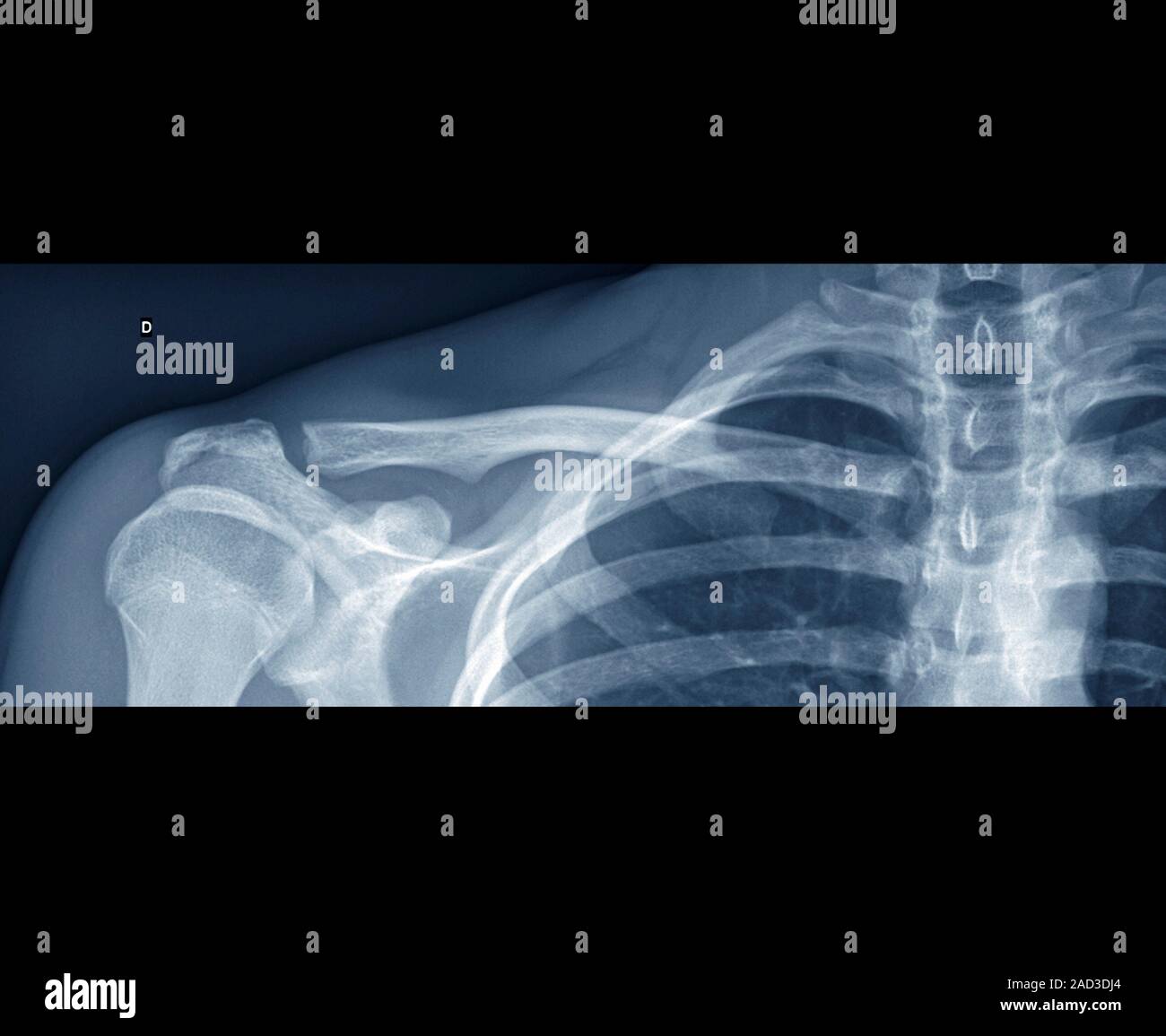 Normal Clavicle Xray The Clavicle: Normal And Abnormal.