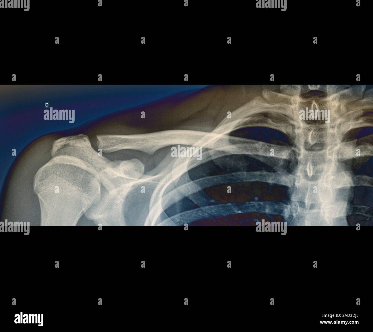 Normal shoulder. X-ray of a section through the right shoulder of a ...