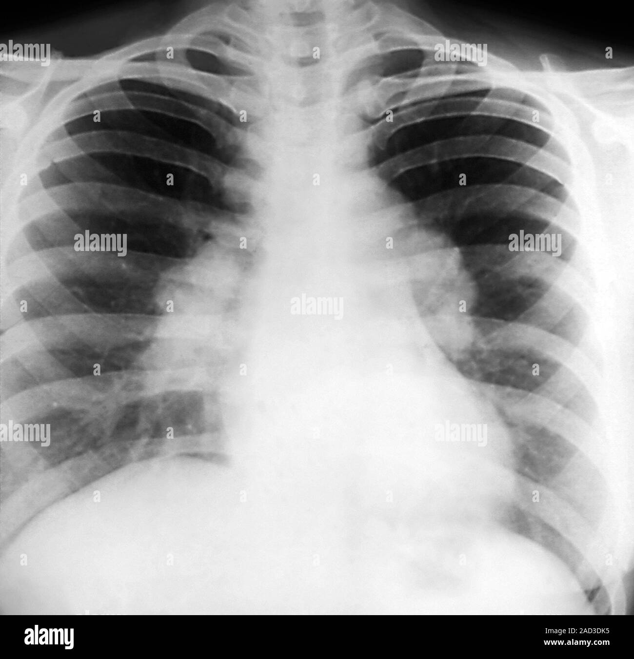 Pulmonary sarcoidosis. Frontal X-ray of the chest of a 49-year-old ...