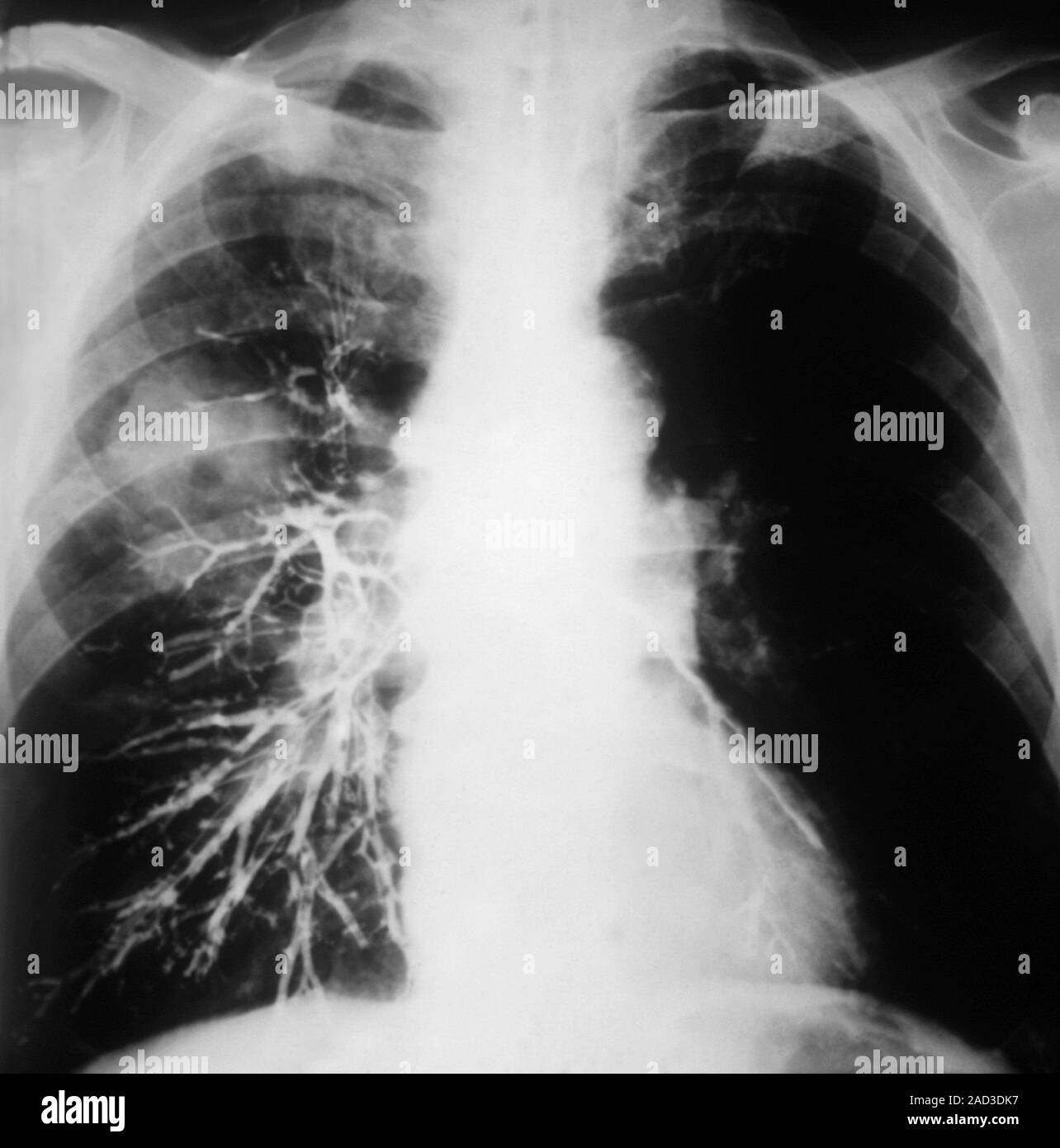 Lung tumour. Frontal chest bronchogram (X-ray) of a 60-year-old patient ...
