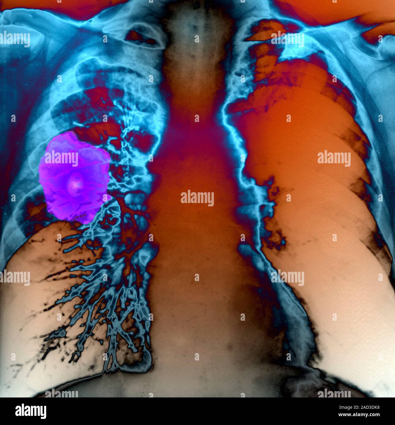 Lung tumour. Coloured frontal chest bronchogram (X-ray) of a 60-year ...