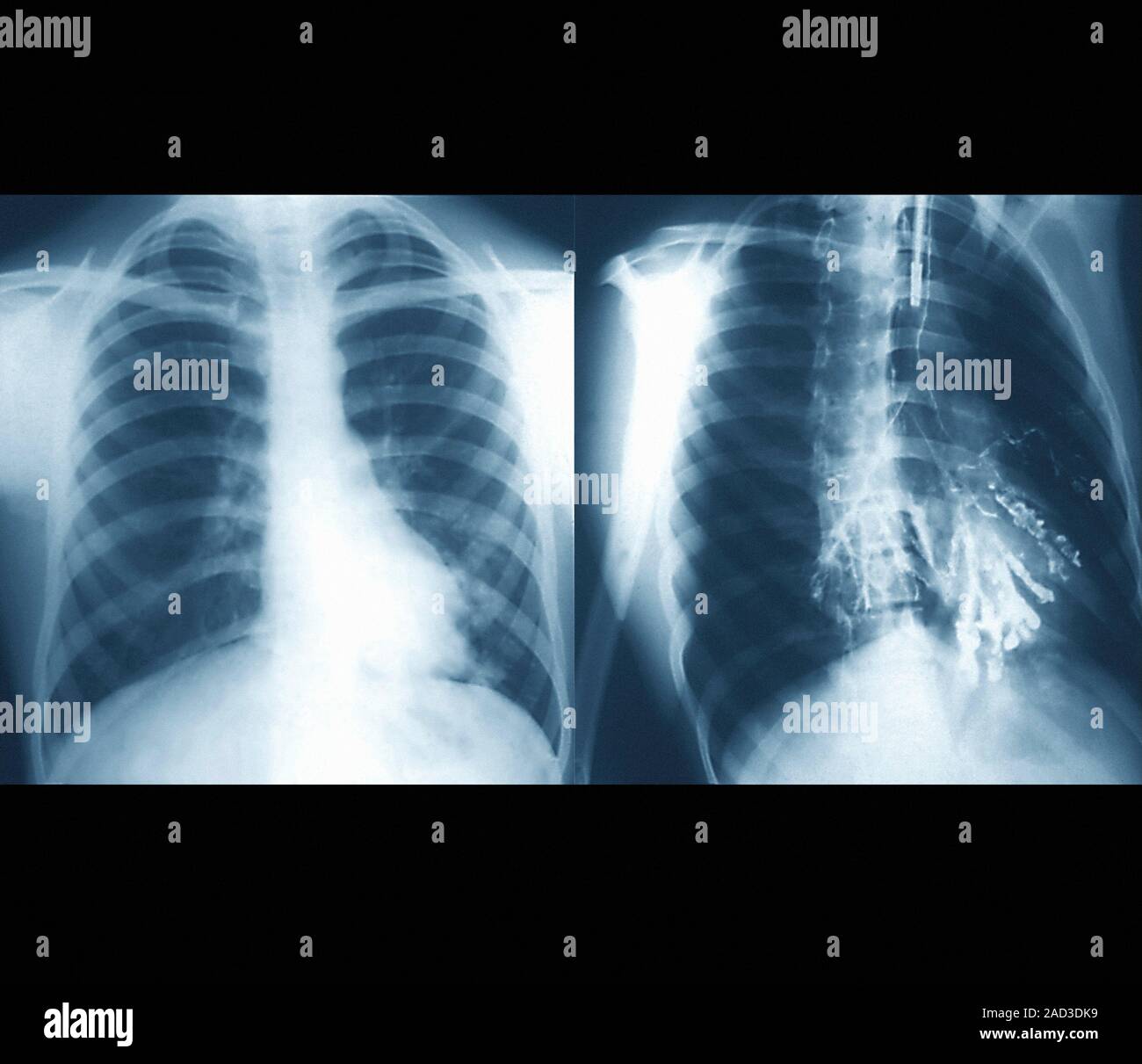 Chest X Ray Bronchiectasis at Fay Davis blog