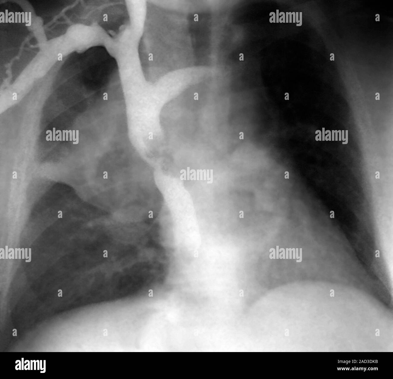 Metastatic lung cancer. Frontal chest X-ray of a 52-year-old patient ...
