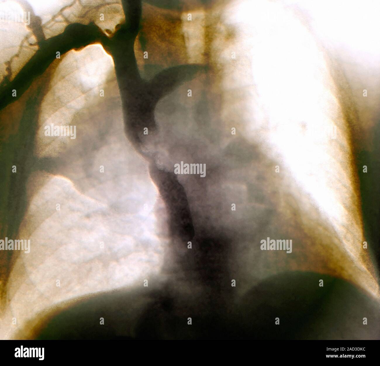 Metastatic lung cancer. Coloured frontal chest X-ray of a 52-year-old ...