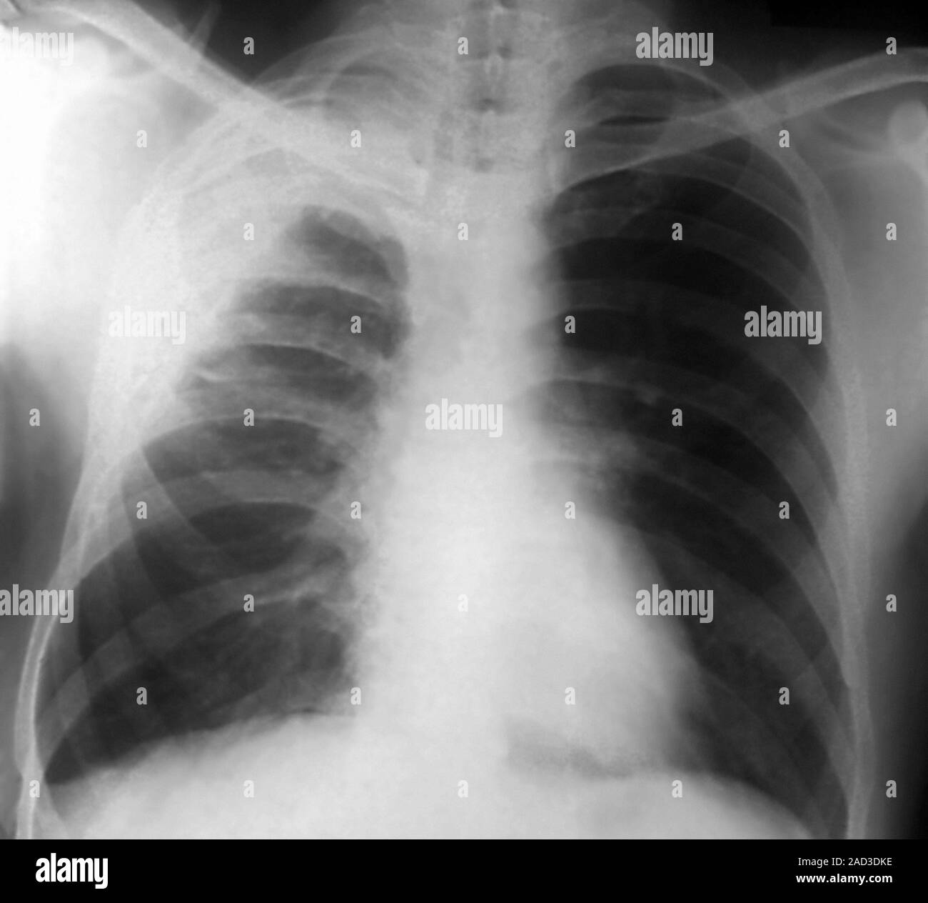 Pleurisy. Frontal X-ray of an axial section through the chest of a 45 ...