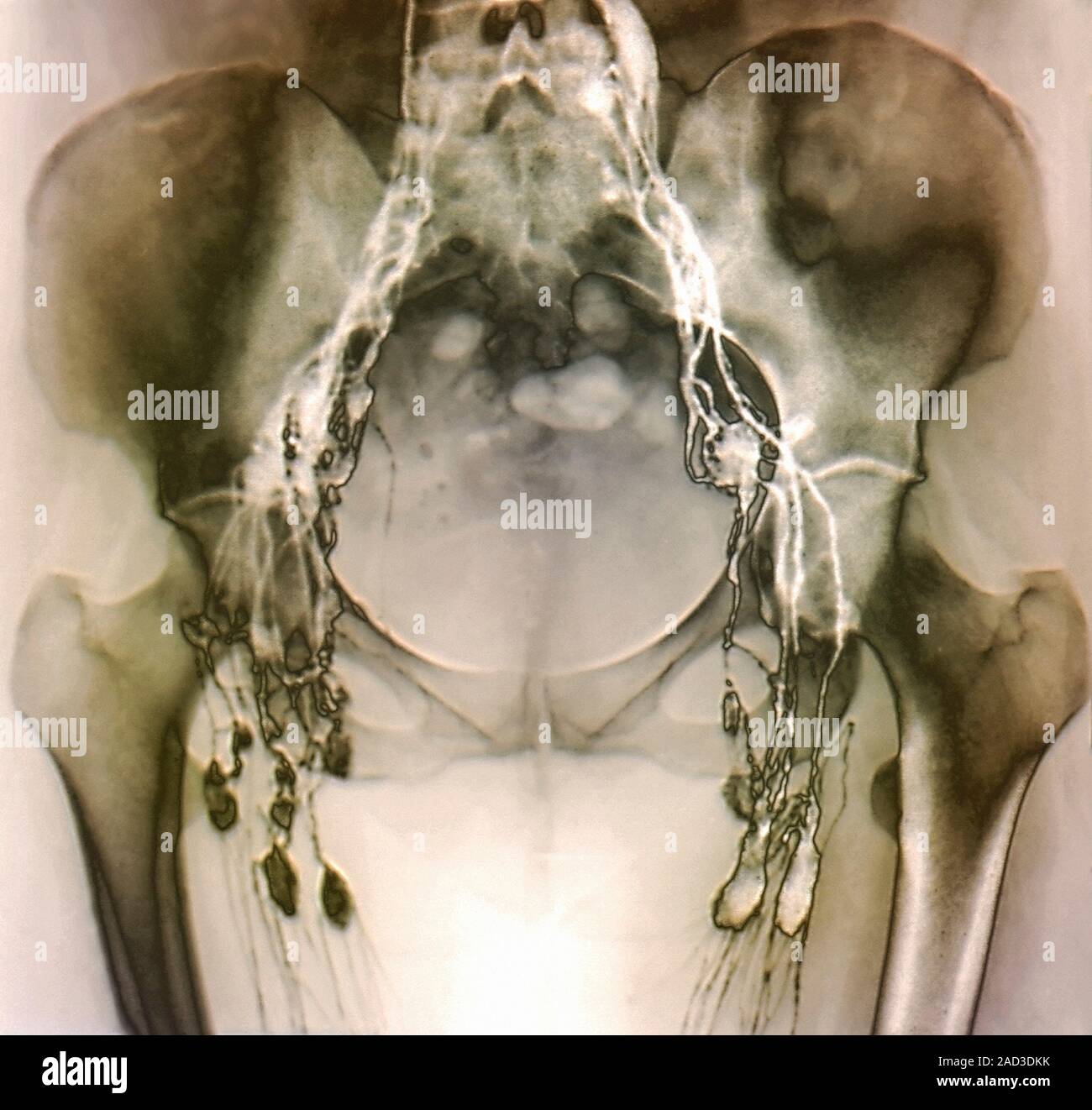 Normal pelvic lymphatic system. Coloured lymphogram (X-ray) of a ...