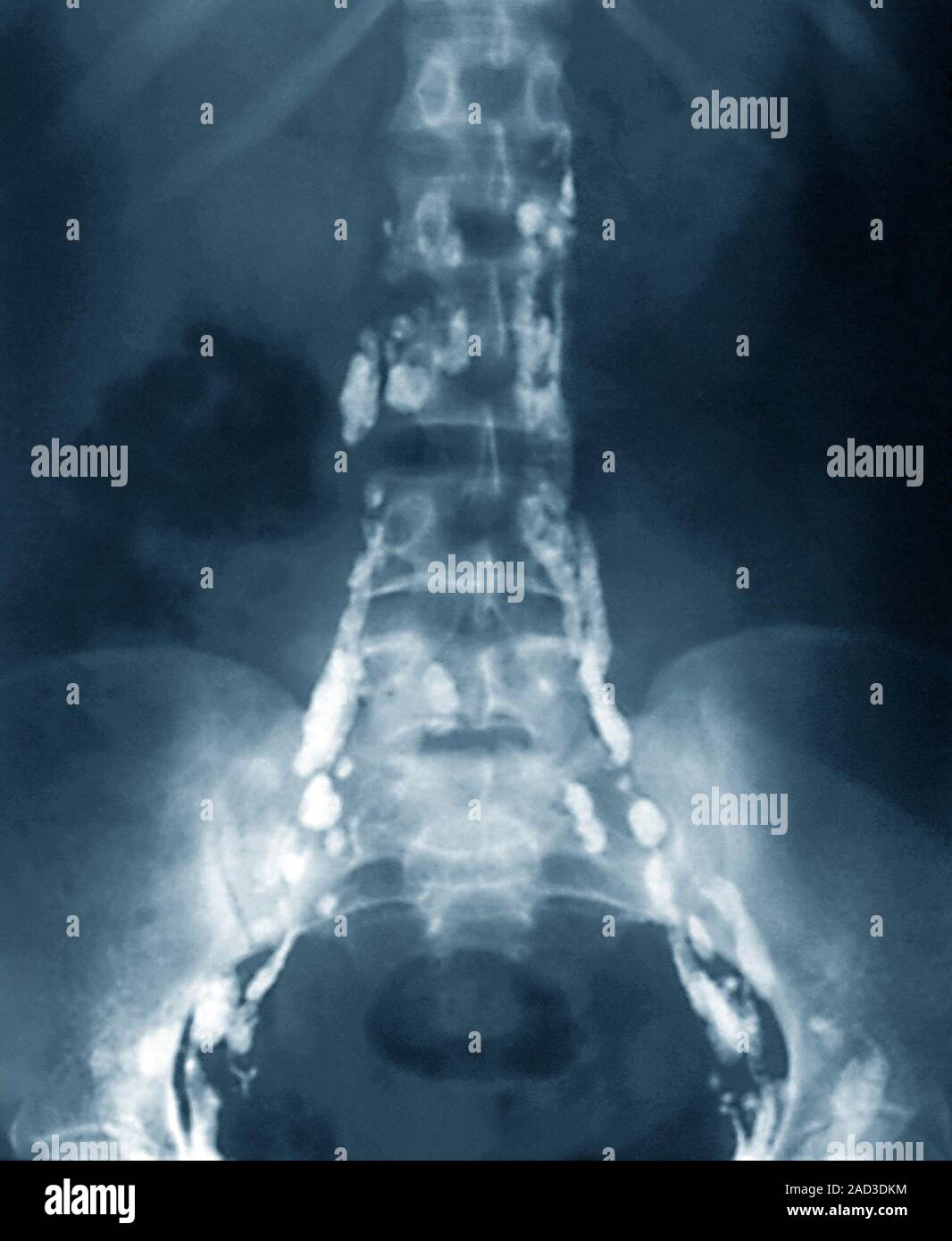 Normal lymphatic system. Lymphogram (X-ray) of a section through the ...