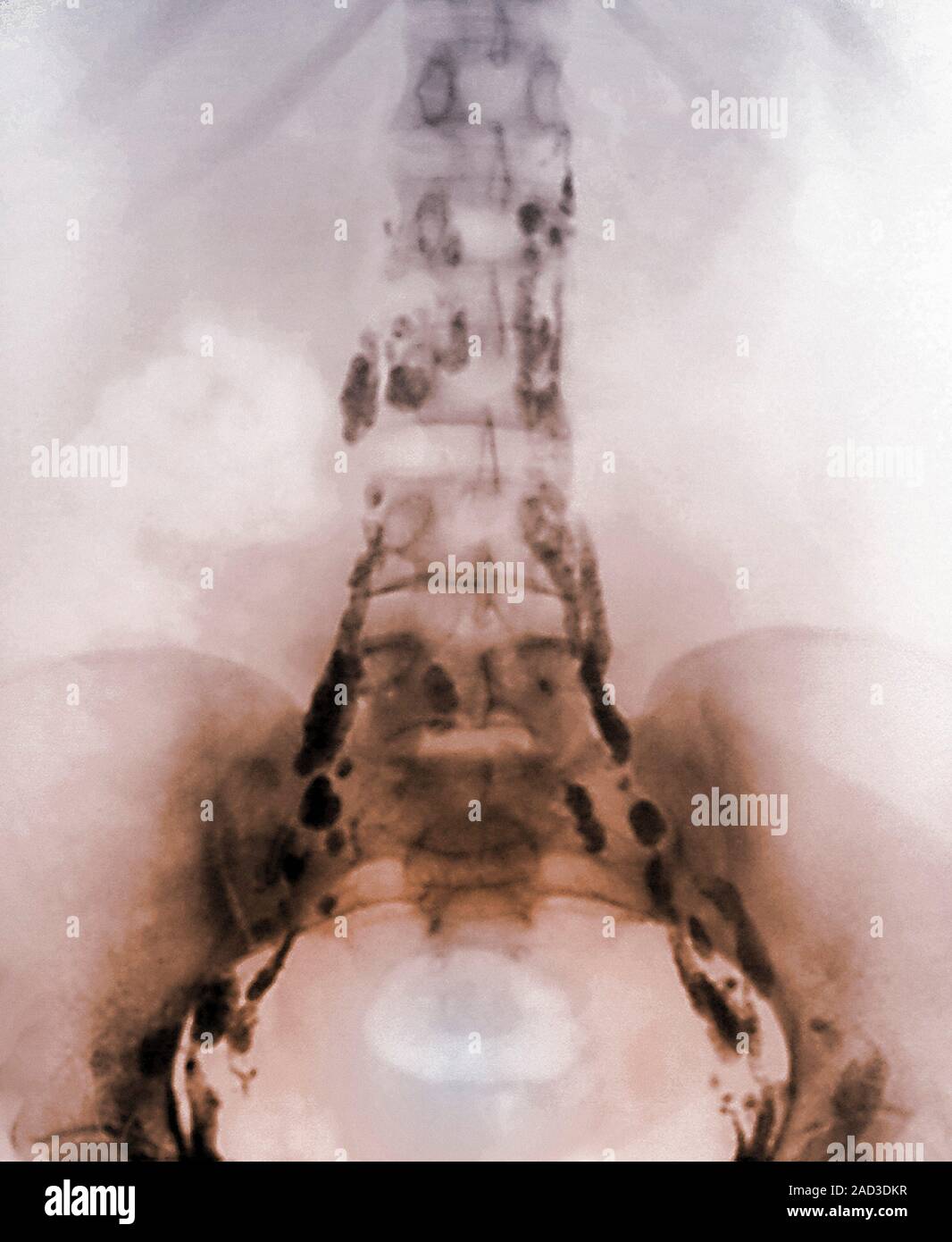 Normal lymphatic system. Coloured lymphogram (X-ray) of a section ...