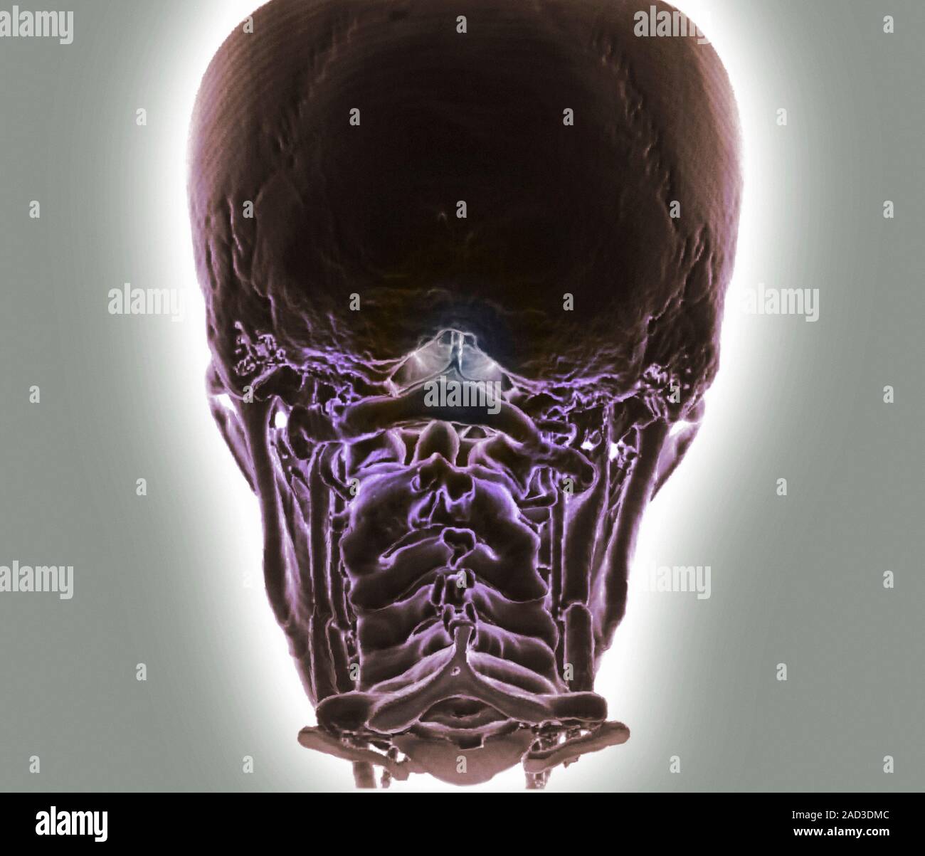Decreased brain blood flow. 3D computed tomography (CT) scan of the ...