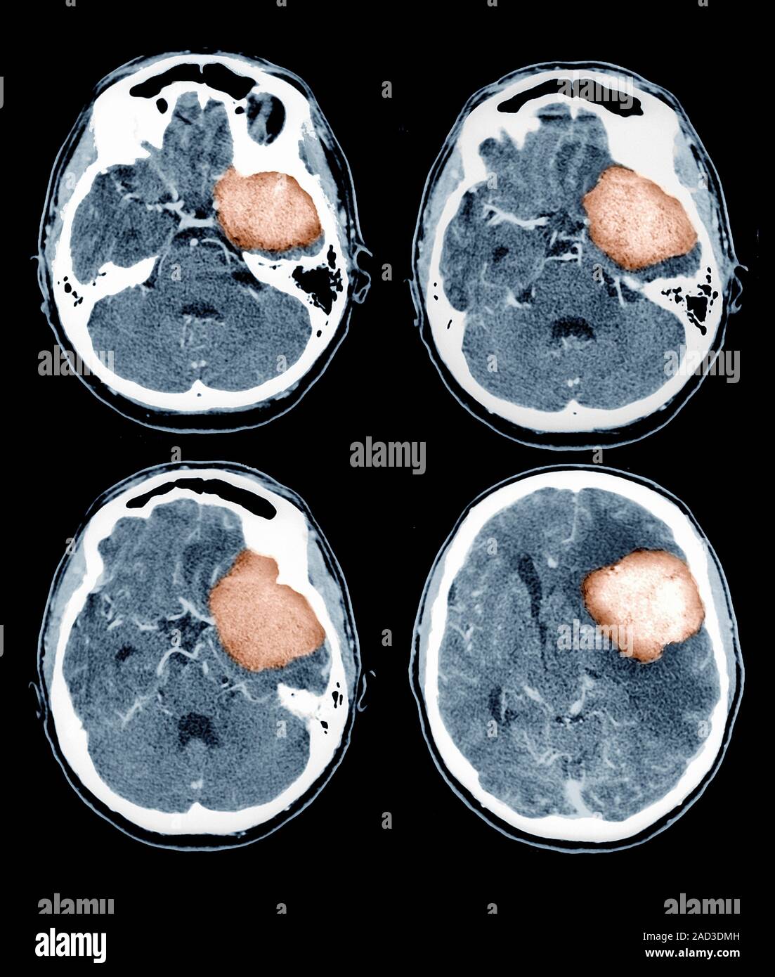 Brain tumour. Coloured computed tomography (CT) scans of sections through the head of a 42-year ...