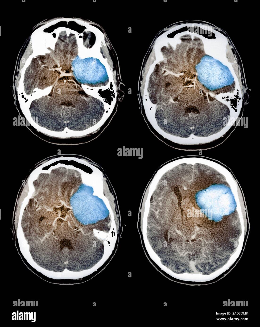 Brain tumour. Coloured computed tomography (CT) scans of sections through the head of a 42-year ...