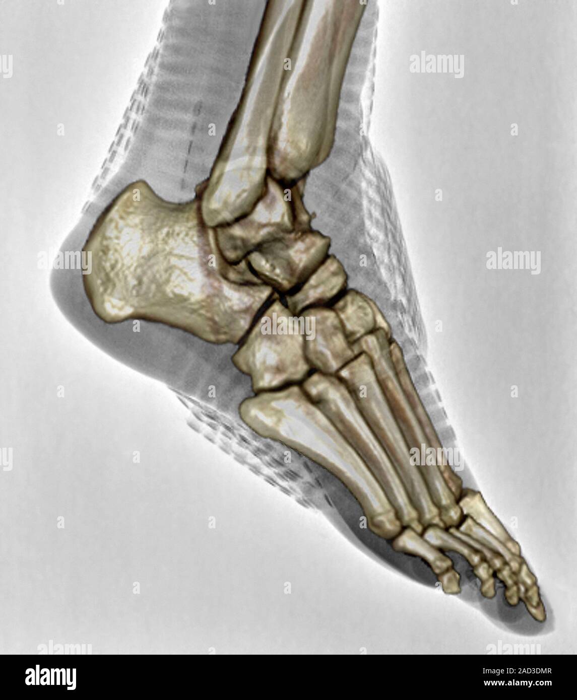 Sprained ankle. Coloured computed tomography (CT) scan of a section ...