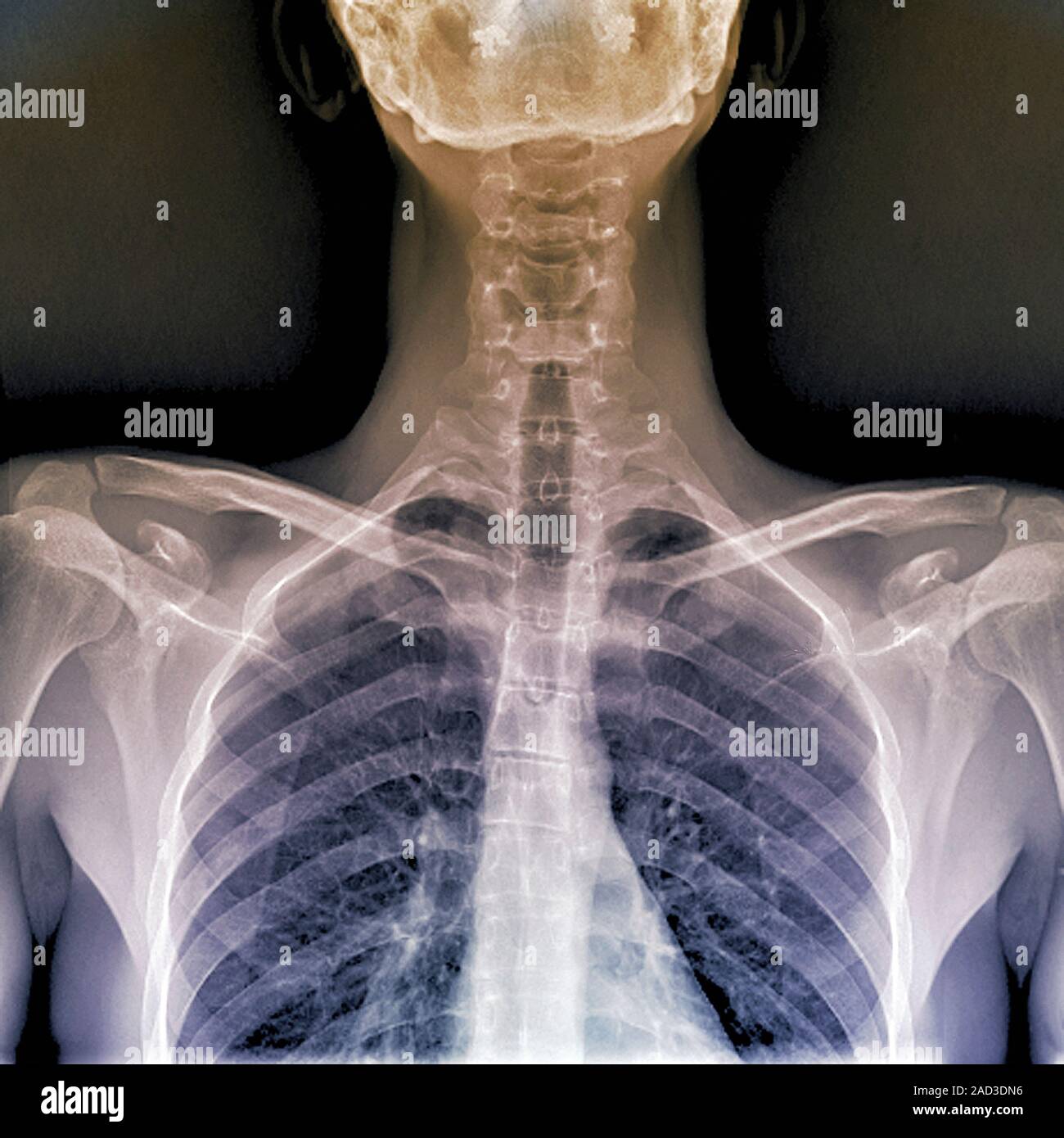 Normal spine. Coloured chest X-ray of a section through the body of a ...