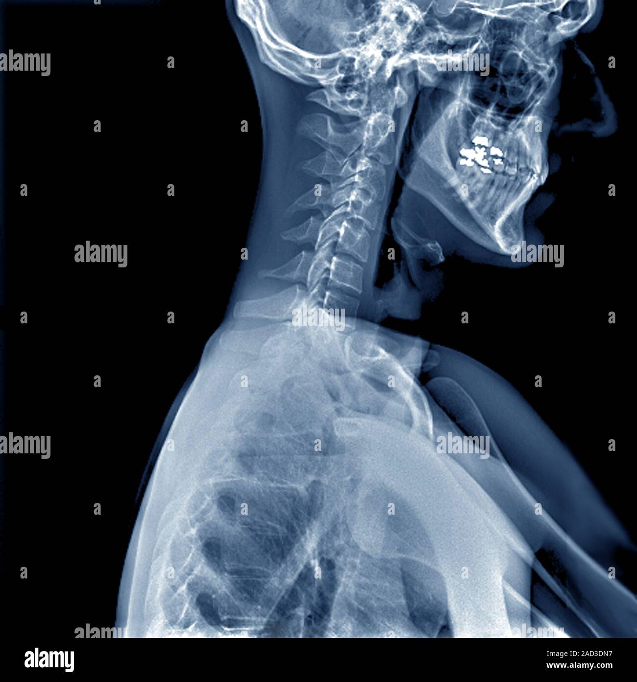 Normal spine. Coloured X-ray of a section through the body of a healthy ...