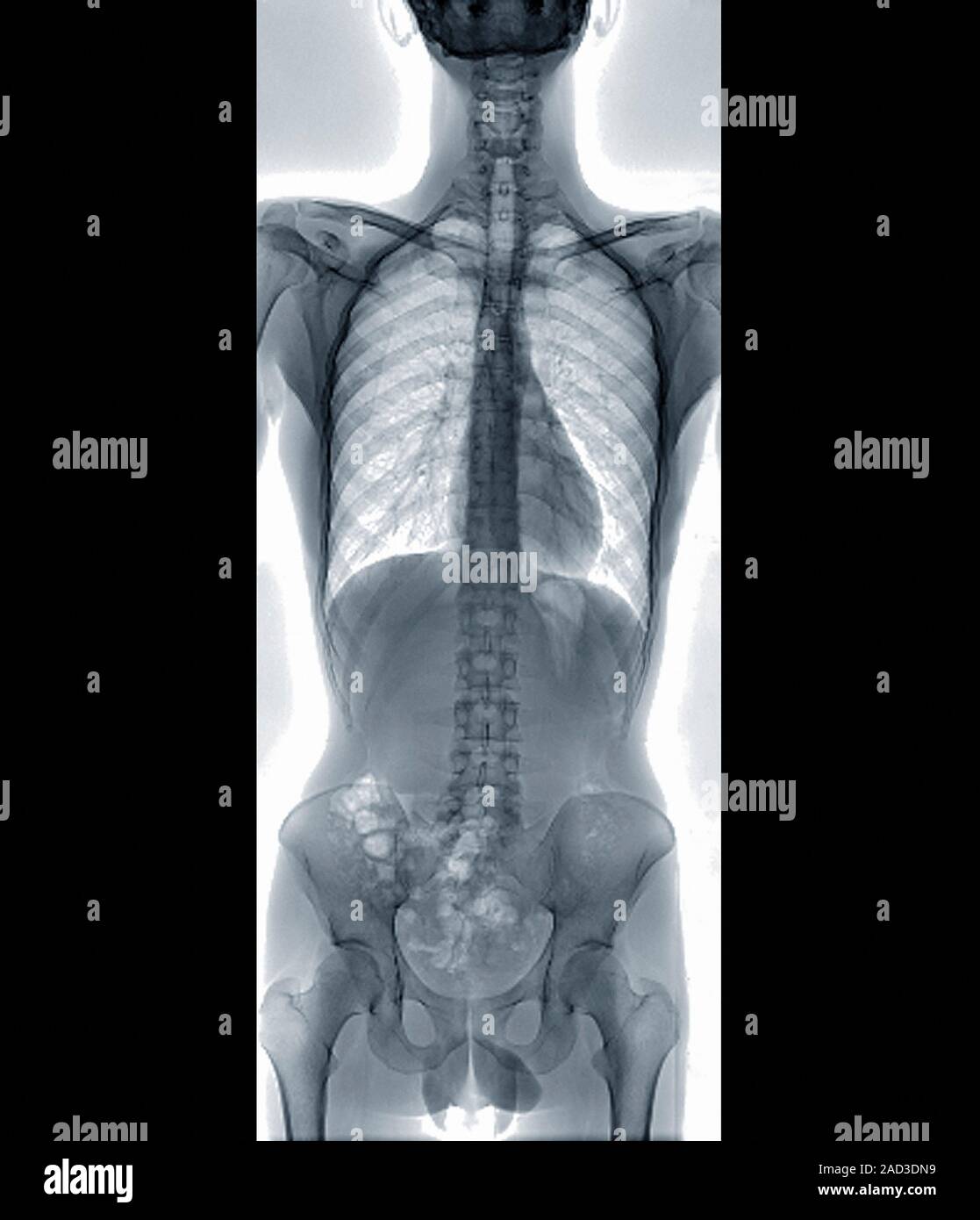 Normal spine. X-ray of a section through the body of a healthy 26-year ...