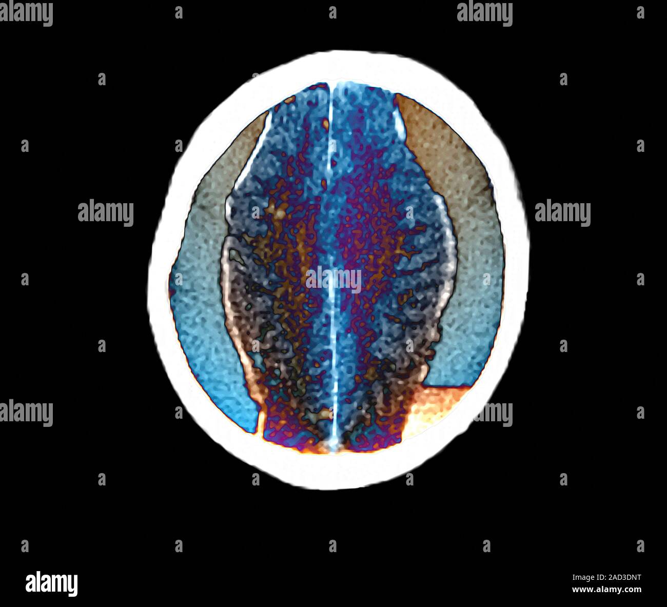 Brain haemorrhage in alcoholism. Computed tomography (CT) scan of a section through the brain of ...