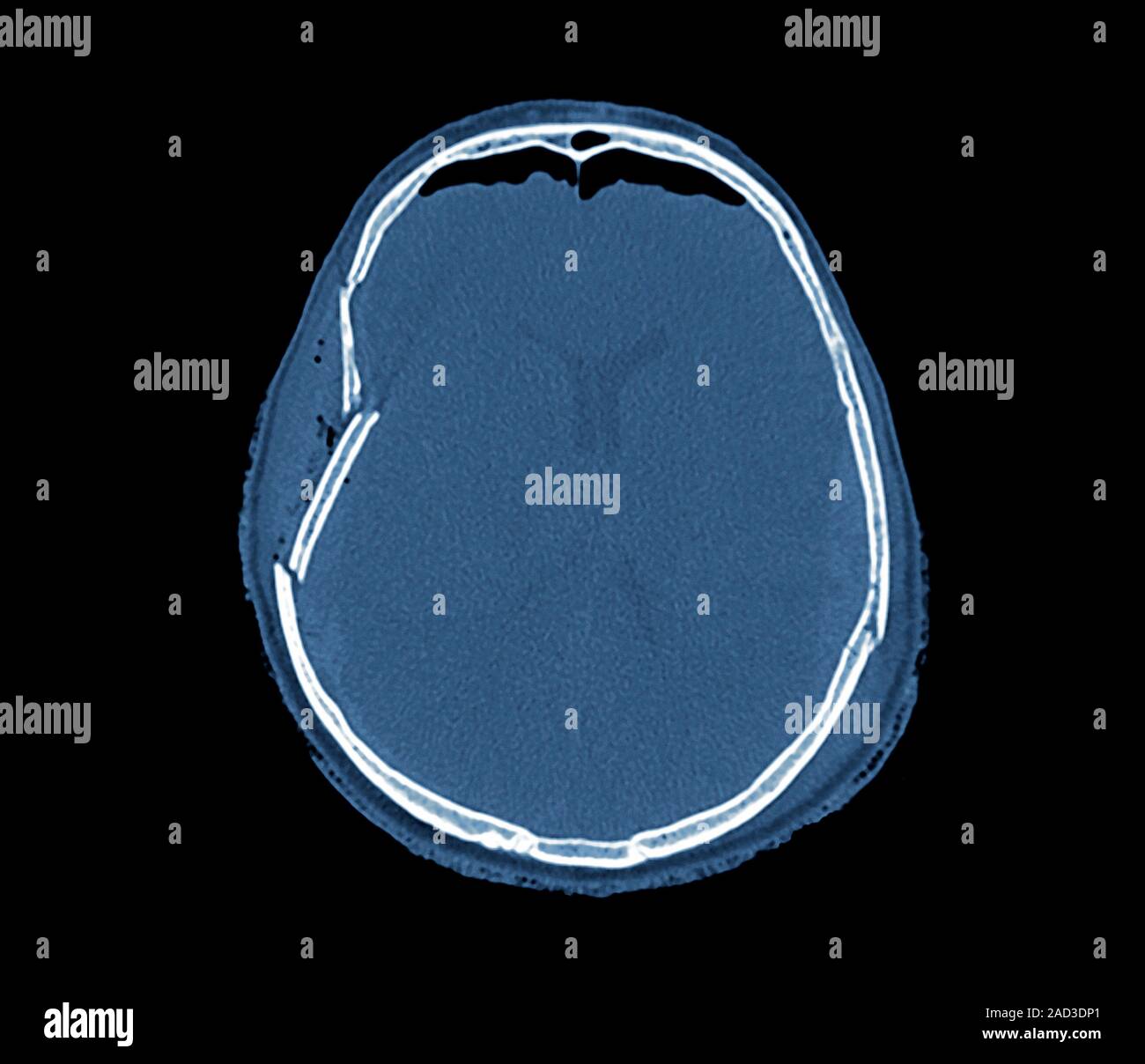 Fractured skull. Coloured computed tomography (CT) scan of a section ...