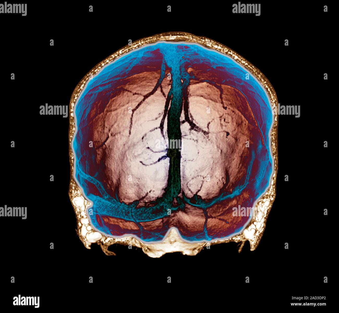 Thrombophlebitis of the brain. Coloured 3D computed tomography (CT) scan showing the cerebral ...