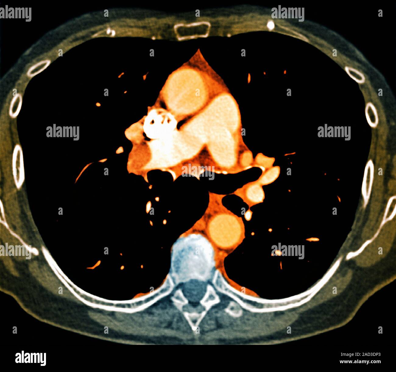 Pulmonary embolism. Coloured computed tomography (CT) scan of an axial ...